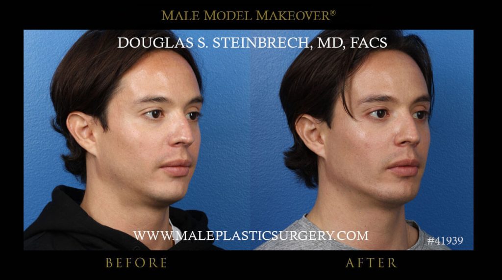 Before & After Compilation - Male Plastic Surgery Chicago