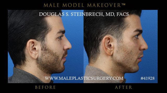 Male Model Makeover - Male Plastic Surgery Chicago